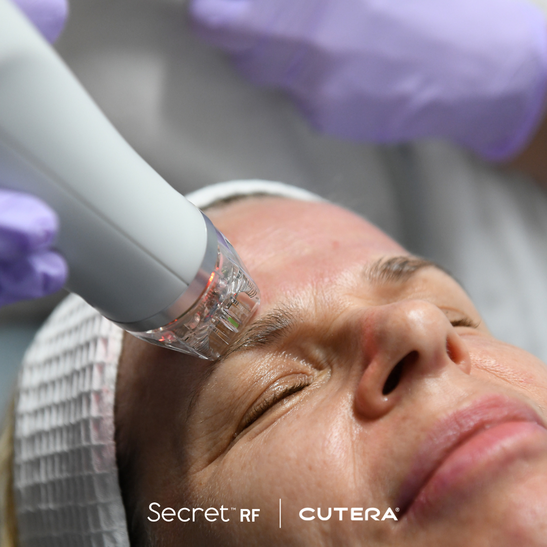 Why Cutera's Secret RF Microneedling Stands Out from the Rest: A Guide ...